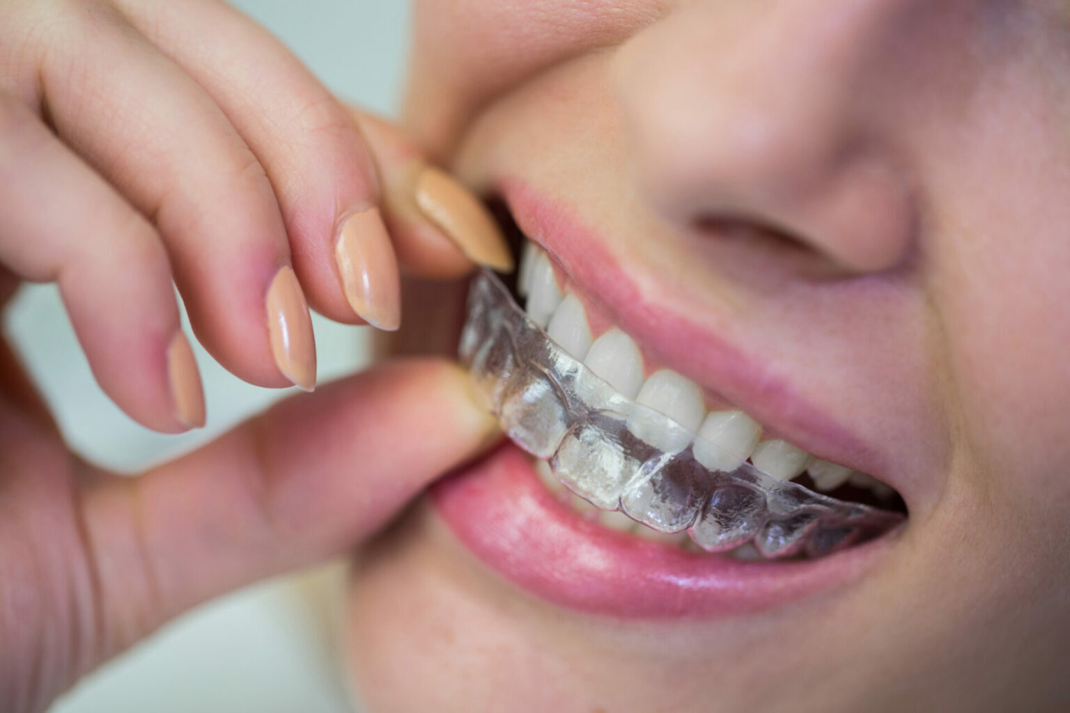 Férula dental o de descarga: ¿Qué es y para qué sirve?